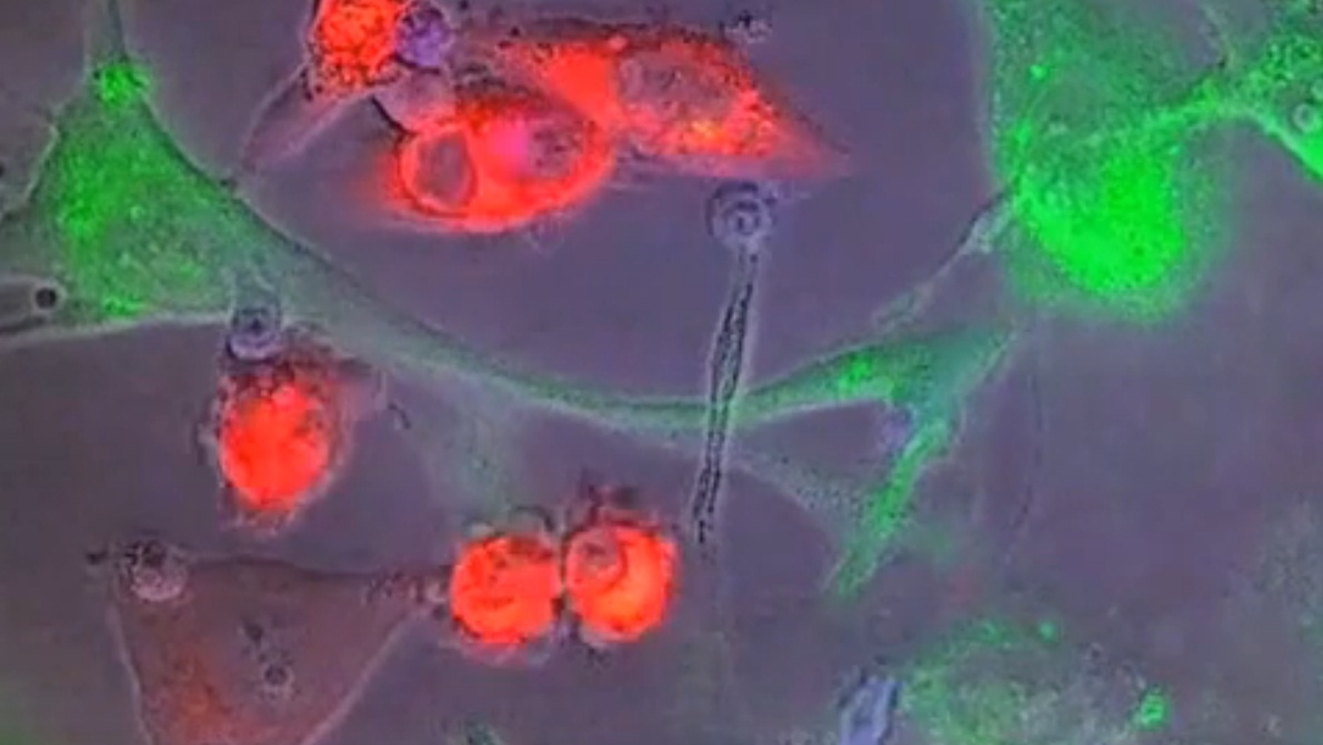 Limfocitele modificate genetic doboară leucemia în 100% din cazuri