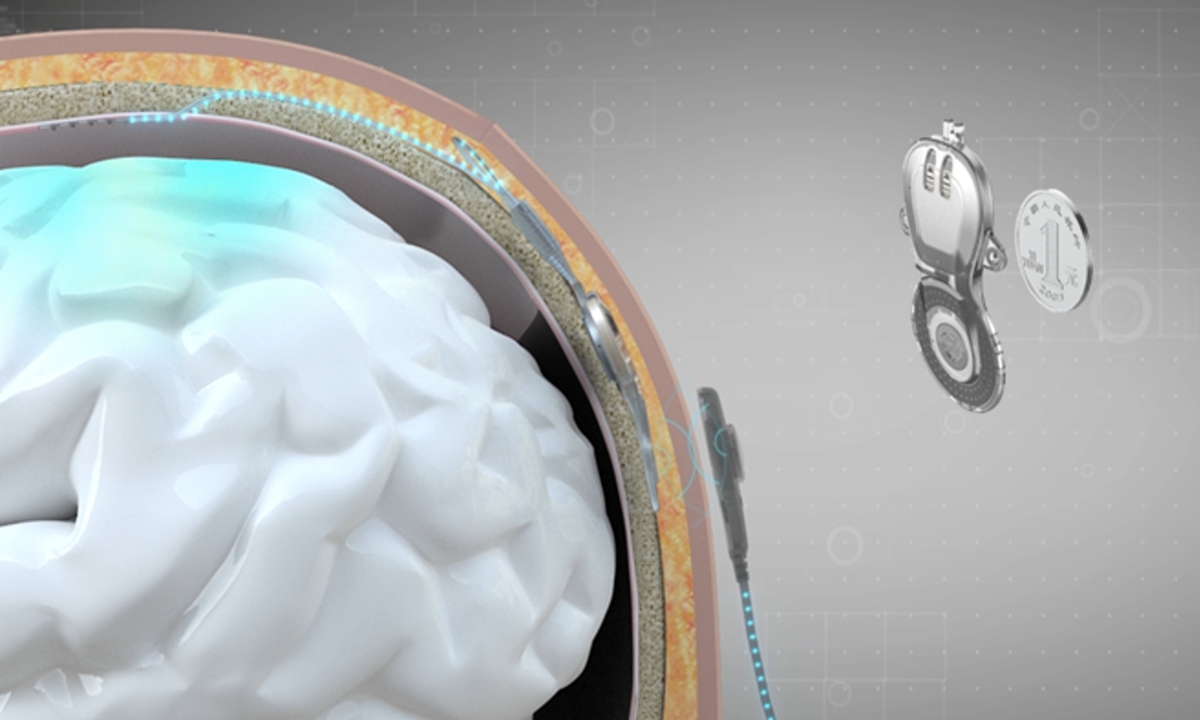 Un implant cerebral revoluționar: China prezintă o alternativă la Neuralink